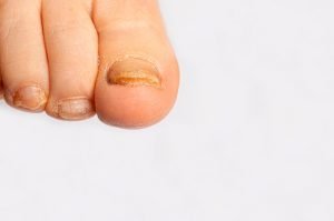 Laser no tratamento da Onicomicose – Angiolaser – Clínica de Angiologia ...